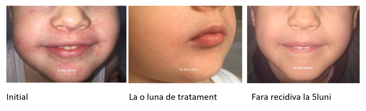 Dermatita periorală cortizonică - Atopyx